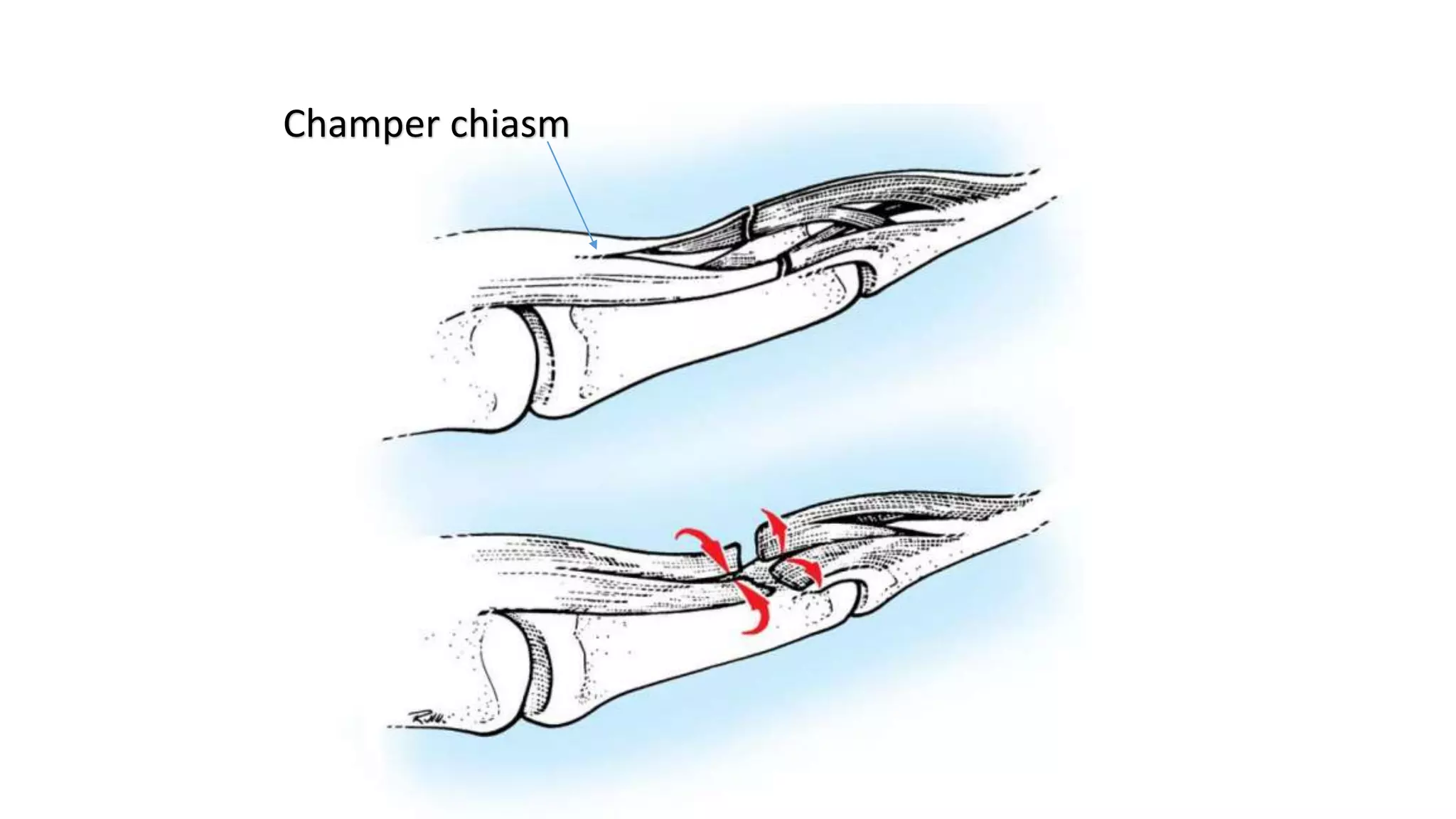 Flexor and extensor tendon injury | PPTX