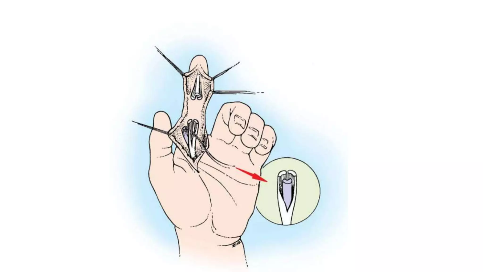 Flexor and extensor tendon injury | PPTX