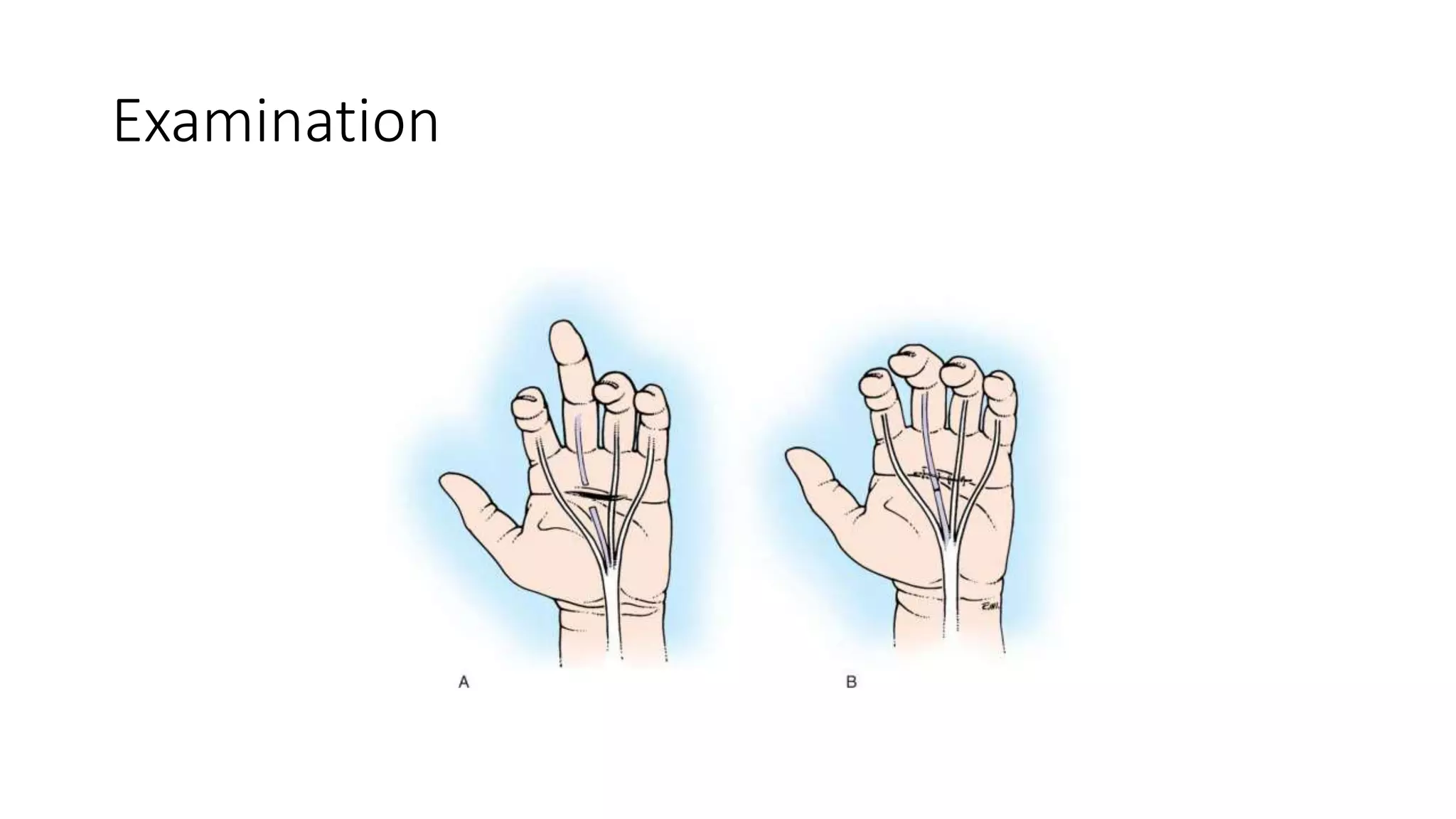 Flexor and extensor tendon injury | PPTX