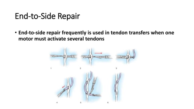 Flexor and extensor tendon injury | PPTX