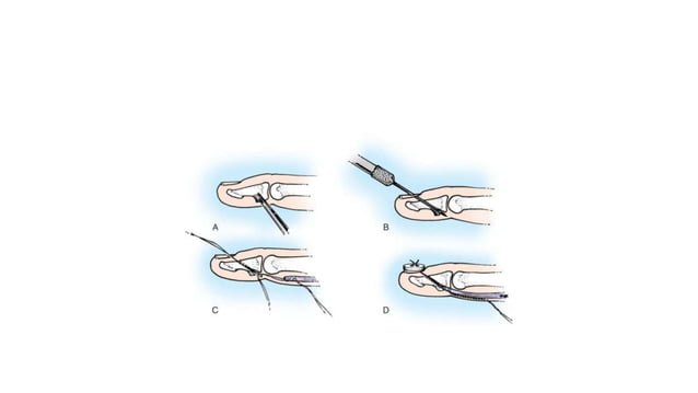 Flexor and extensor tendon injury | PPTX
