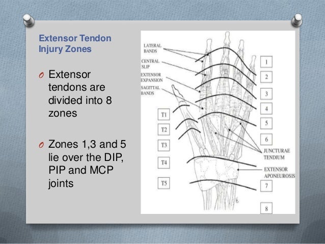 Flexor and Extensor Tendon Laceration vs. Occupational Therapy