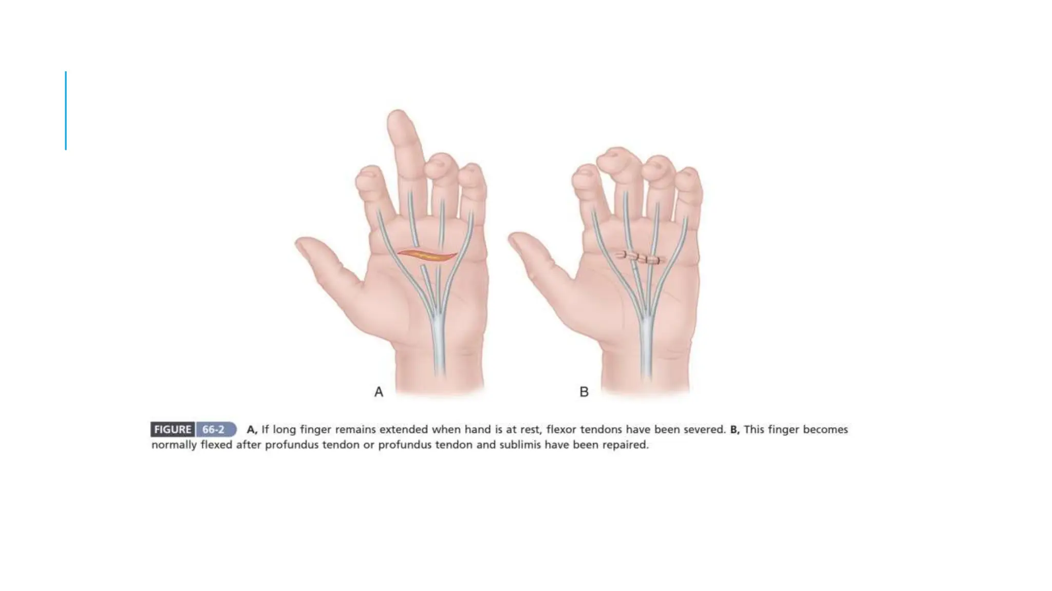 flexor tendon injury hand,flexor tendon injury hand | PPTX