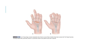 flexor tendon injury hand,flexor tendon injury hand | PPT