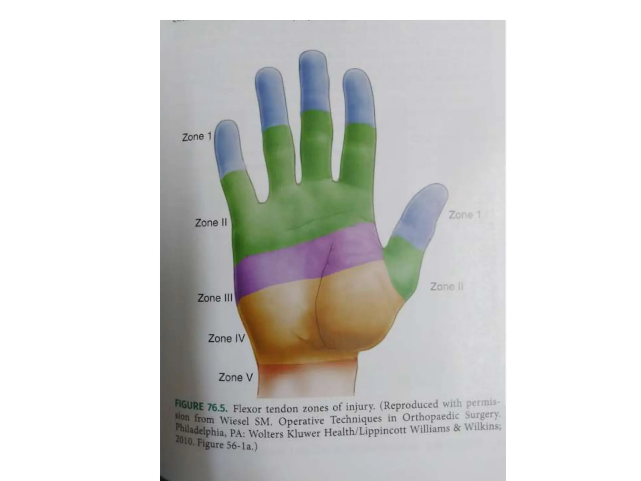 FLEXOR TENDON injury, fds,fdp,tendon injury | PPT