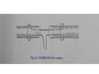 FLEXOR TENDON injury, fds,fdp,tendon injury | PPT