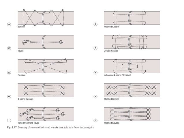 FLEXOR TENDON injury, fds,fdp,tendon injury | PPT