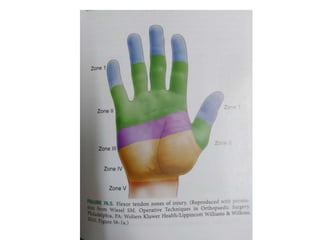 FLEXOR TENDON injury, fds,fdp,tendon injury | PPT