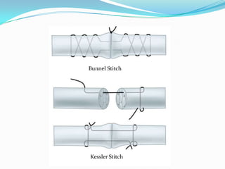 Flexor tendon injuries_UTSAV | PPT