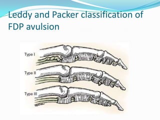 Flexor tendon injuries_UTSAV | PPT