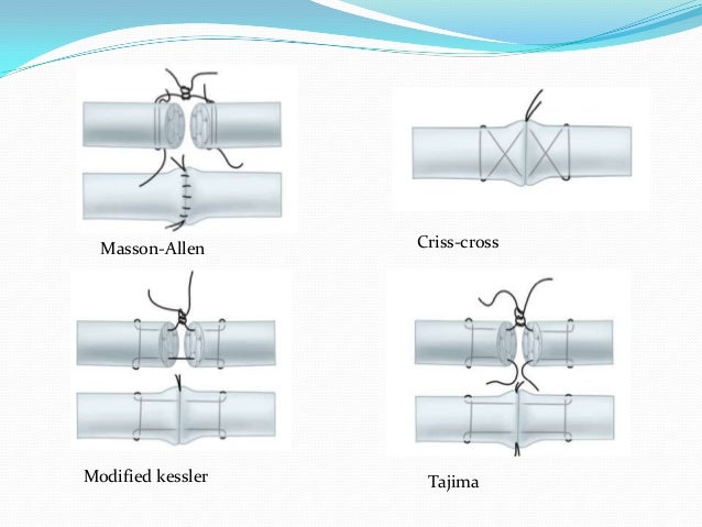 Flexor tendon injuries_UTSAV
