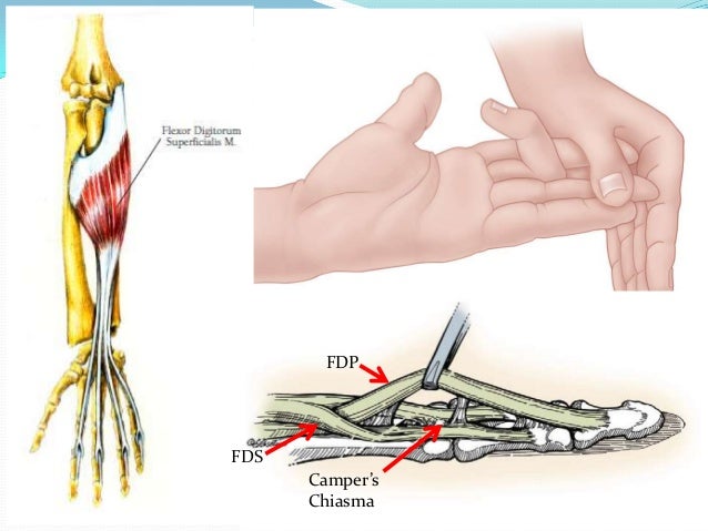 Flexor tendon injuries_UTSAV