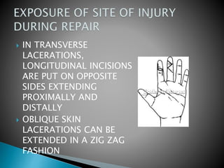 Flexor tendon injuries | PPTX