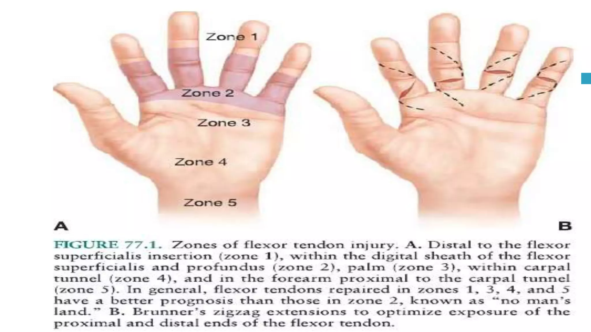 Flexor tendon injuries | PPTX