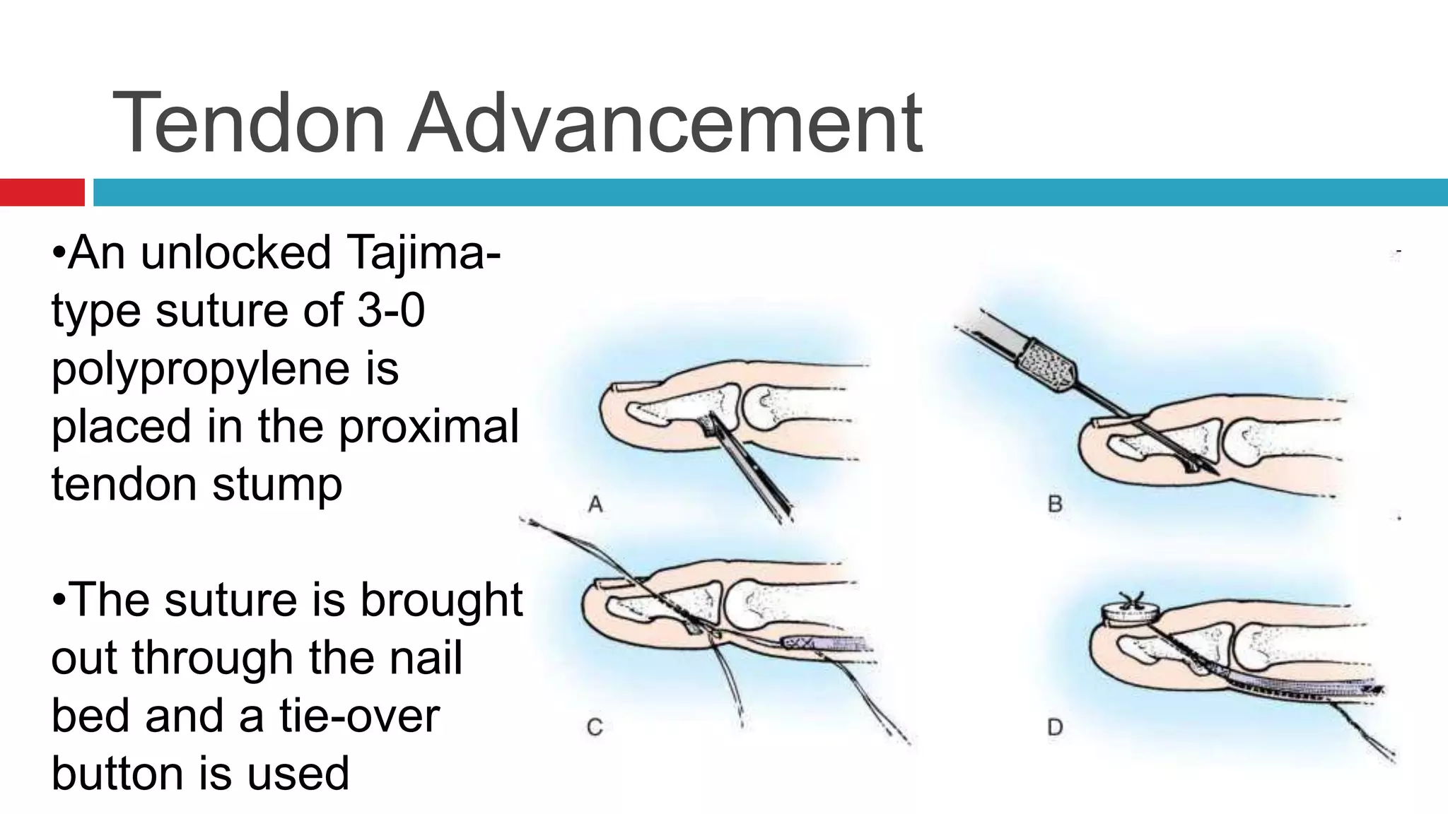 Flexor tendon injuries | PPTX