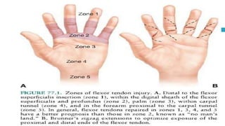 Flexor Tendon Injury Zones Page Zone 2: No Man's Land, 59% OFF