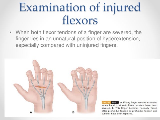 Flexor tendon injuries