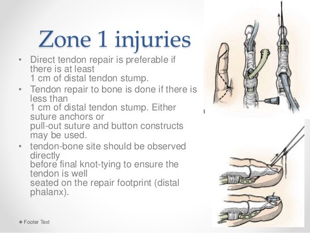 Flexor tendon injuries