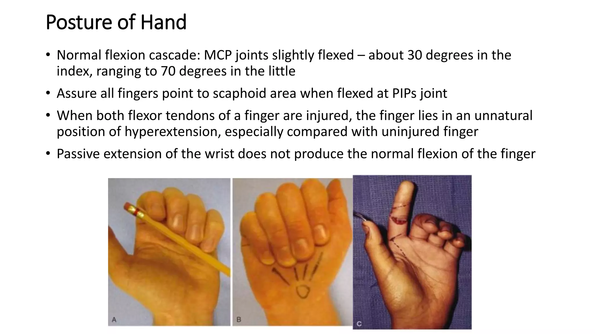 Flexor tendon injuries slideshare | PPTX