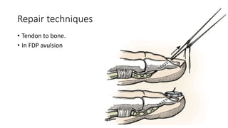 Flexor tendon injuries | PPTX
