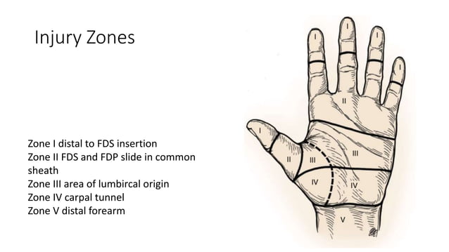 Flexor tendon injuries | PPT