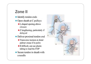 Flexor tendon injuries- basics for orthopedics residents | PPTX