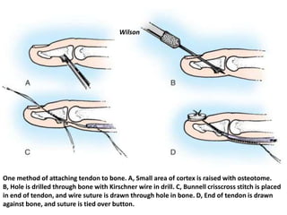 Flexor tendon injuries.m | PPTX
