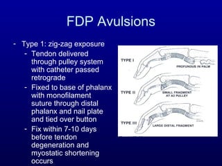 Flexortendoninjuries1 140504003542-phpapp01 | PPT