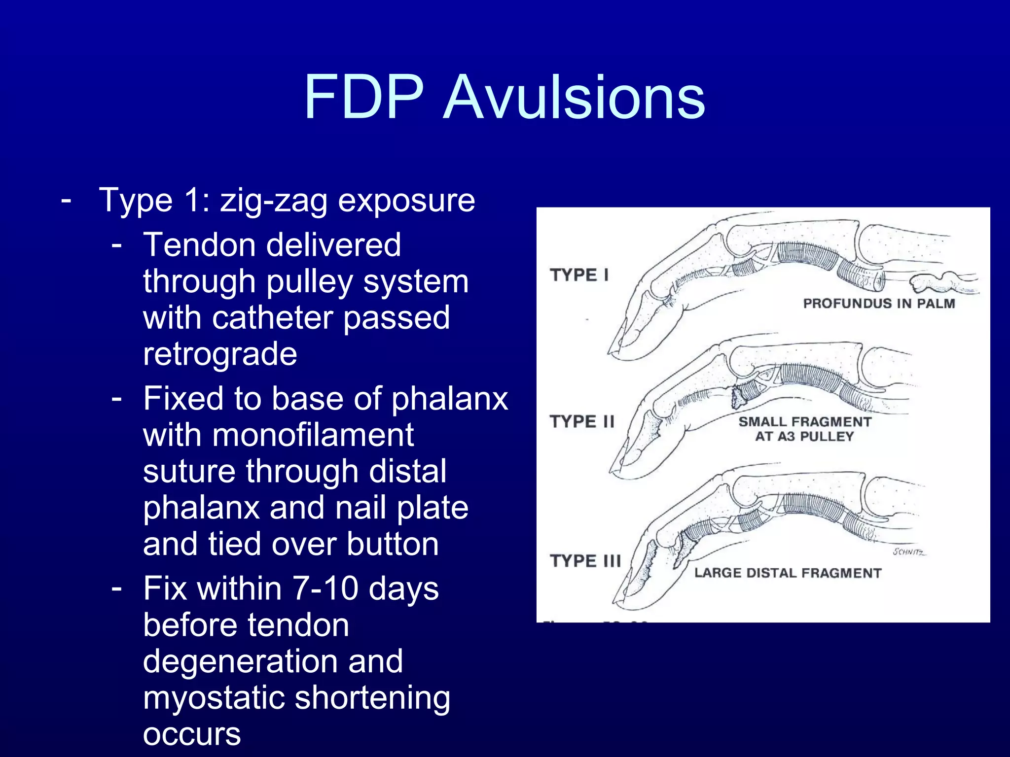 Flexor tendon injuries(1) | PPT