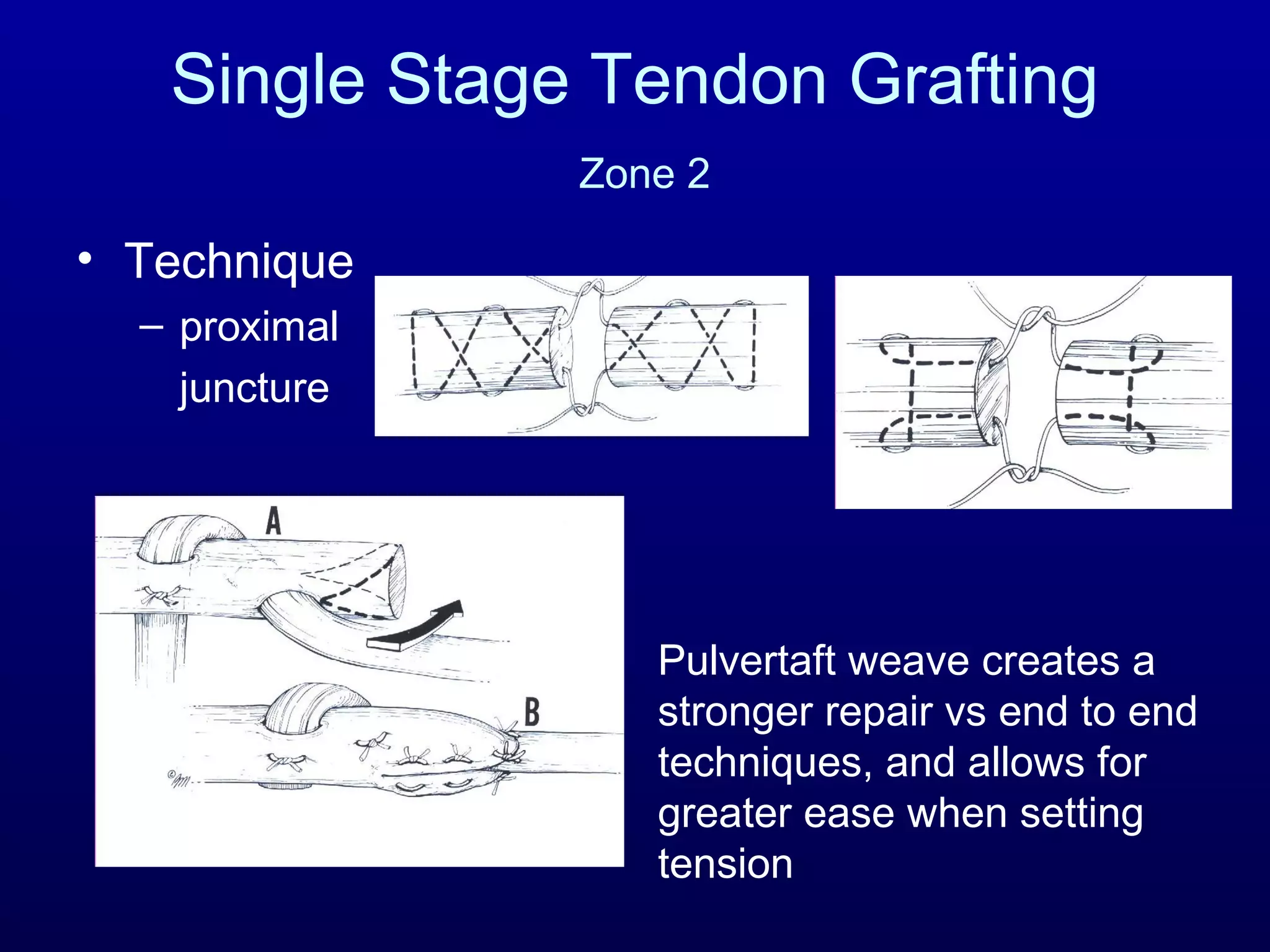 Flexor tendon injuries(1) | PPT