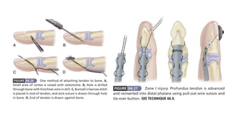 Flexor Tendon injuries and repair...pptx