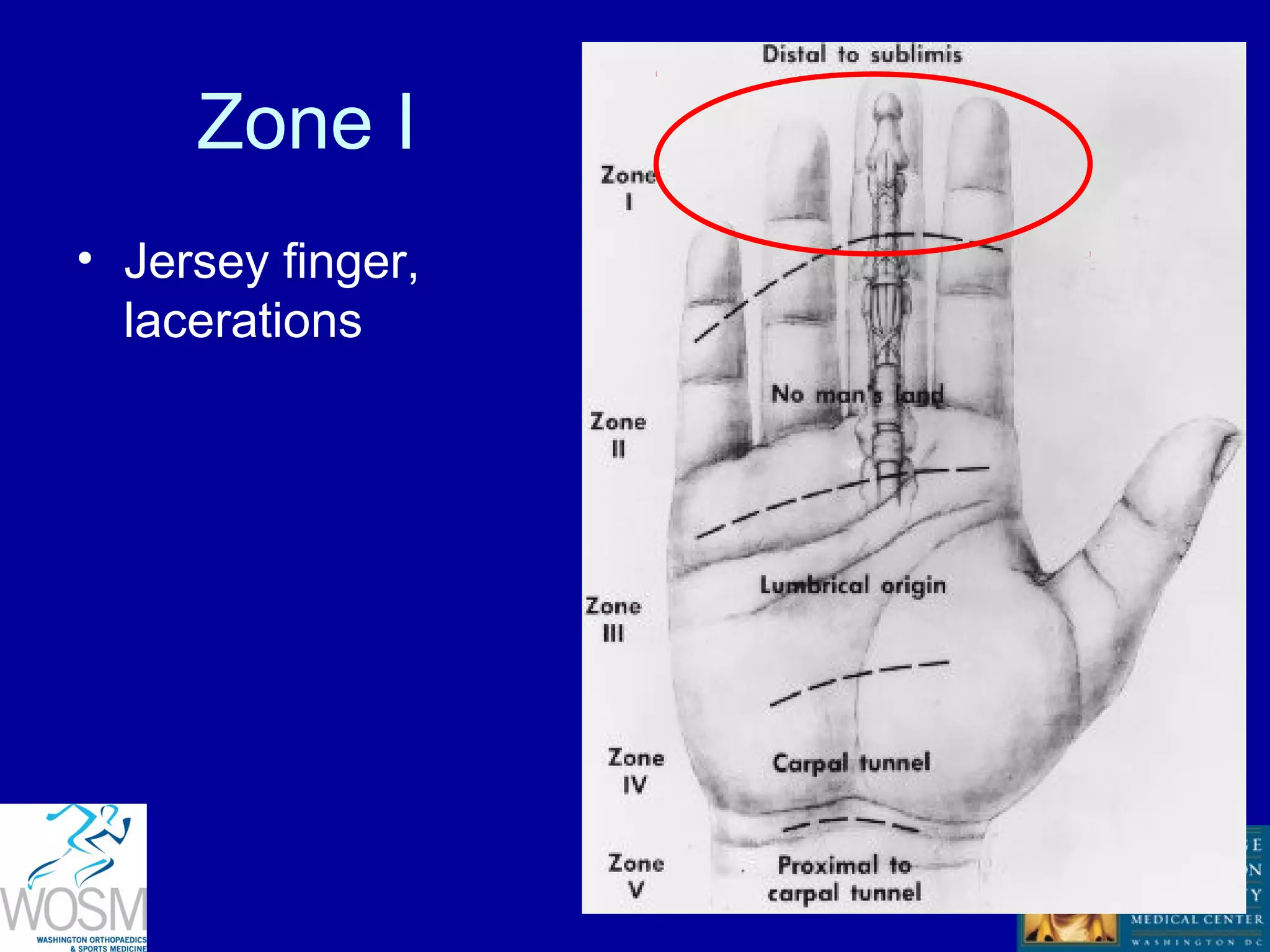 Flexor tendon injuries of the hand | PPT
