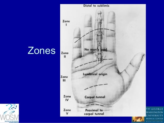 Flexor tendon injuries of the hand