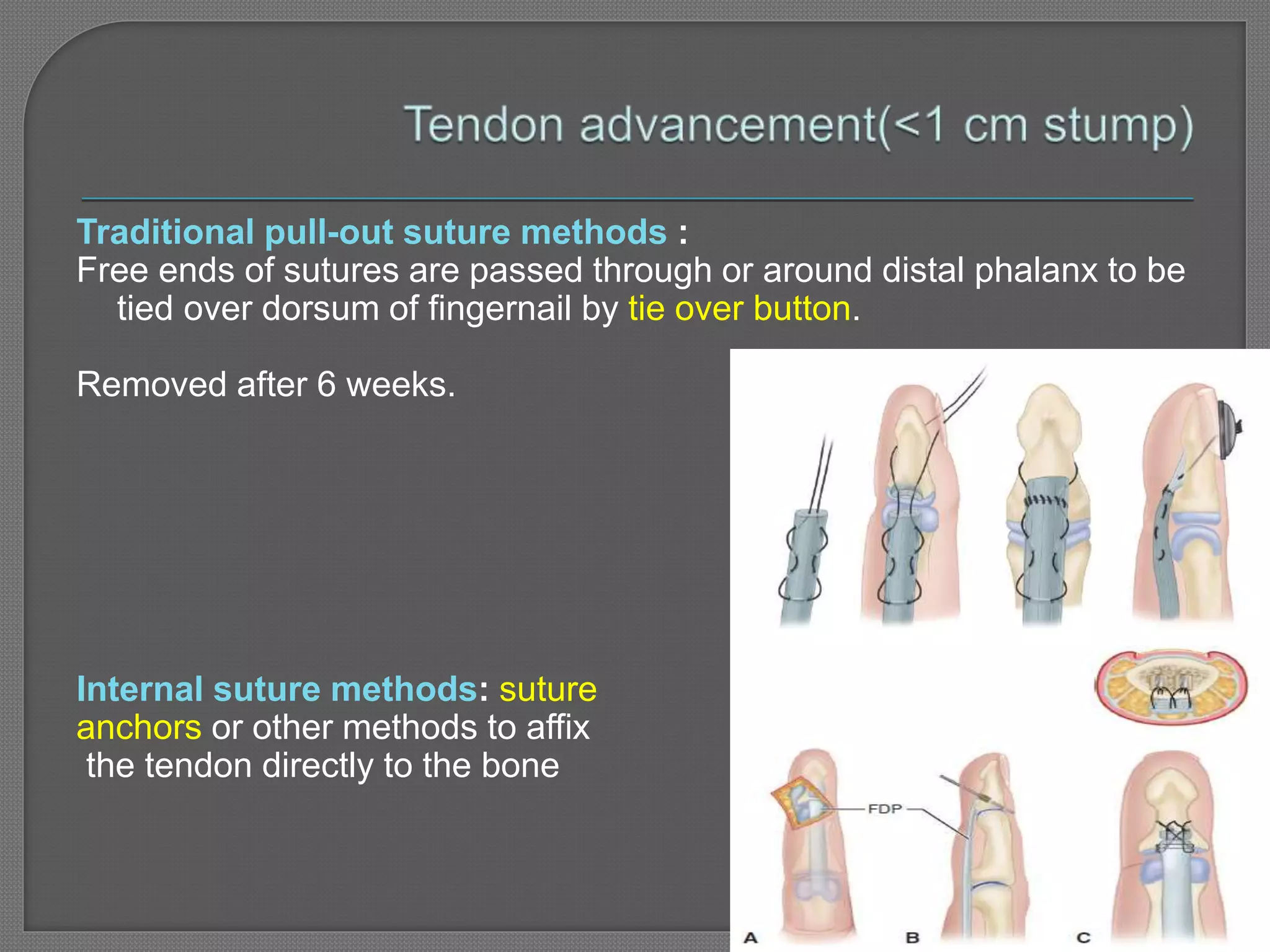 Flexor tendon injury | PPTX