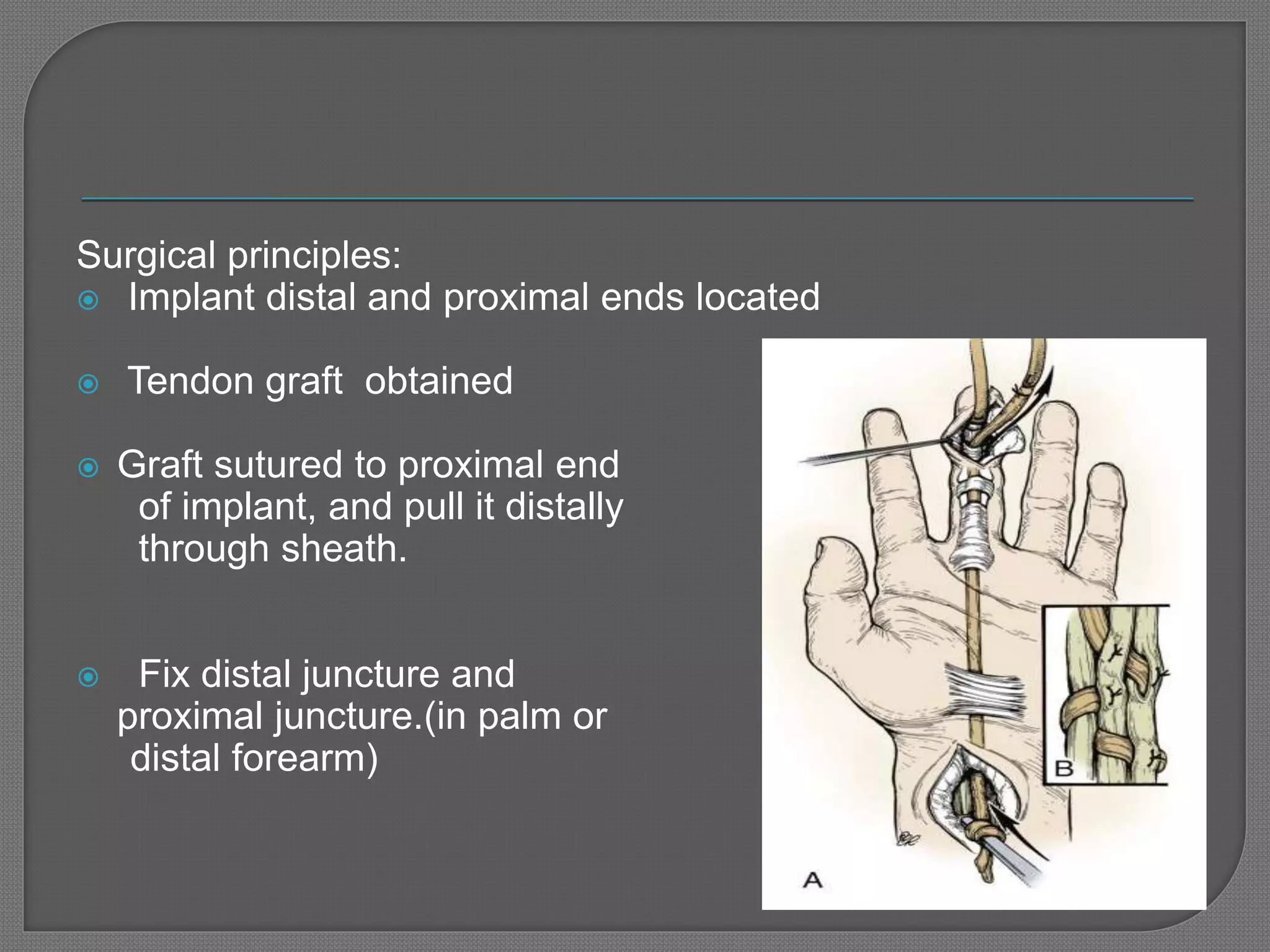 Flexor tendon injury | PPTX