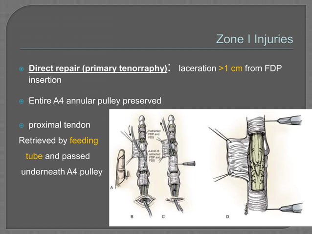 Flexor tendon injury | PPTX | Death, Injury, or Military Conflict ...