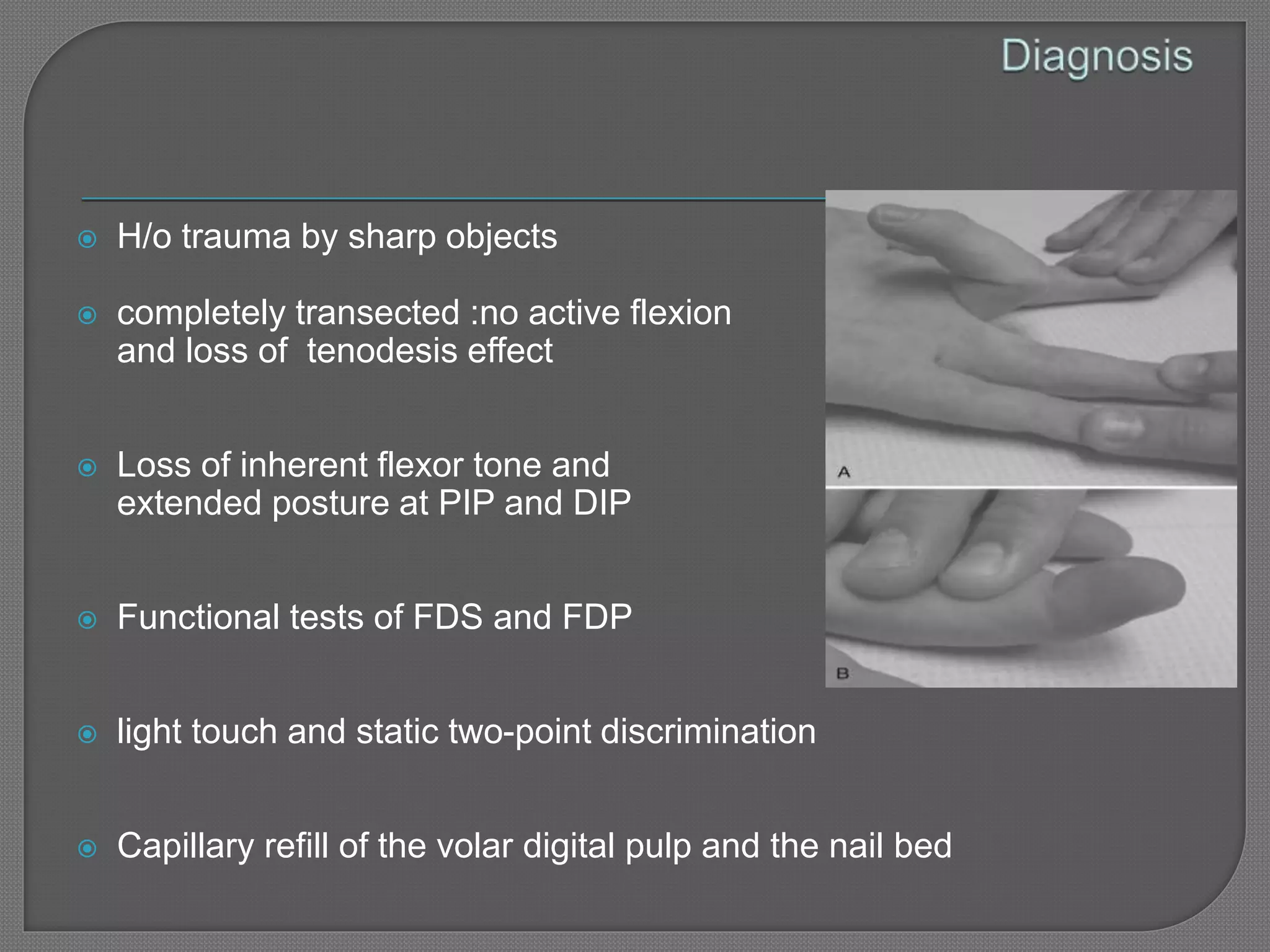 Flexor tendon injury | PPTX