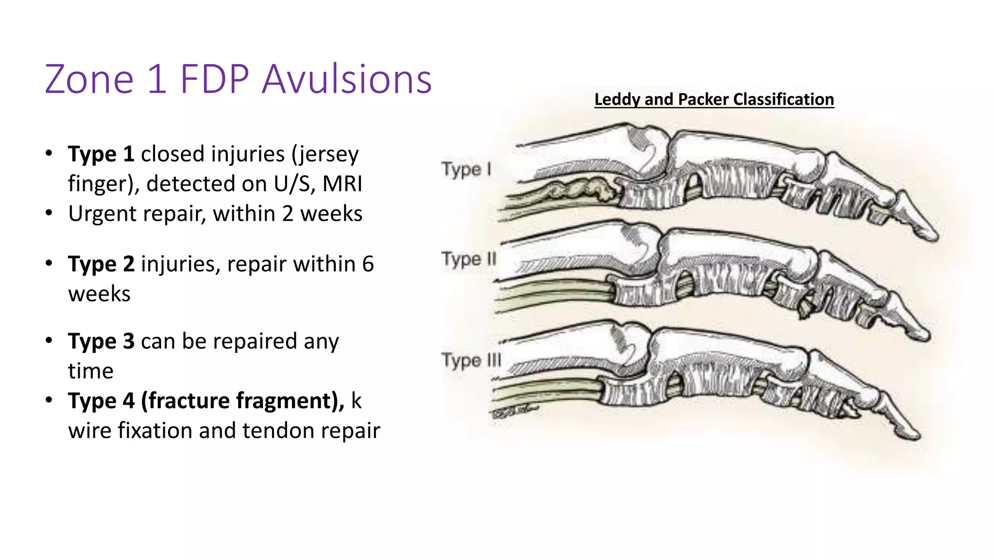 Flexor tendon injury | PPT