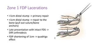 Flexor tendon injury | PPT