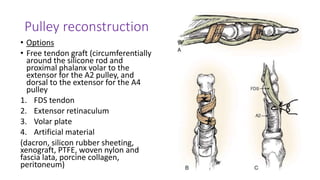 Flexor tendon injury | PPT