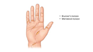 Flexor tendon injury | PPT
