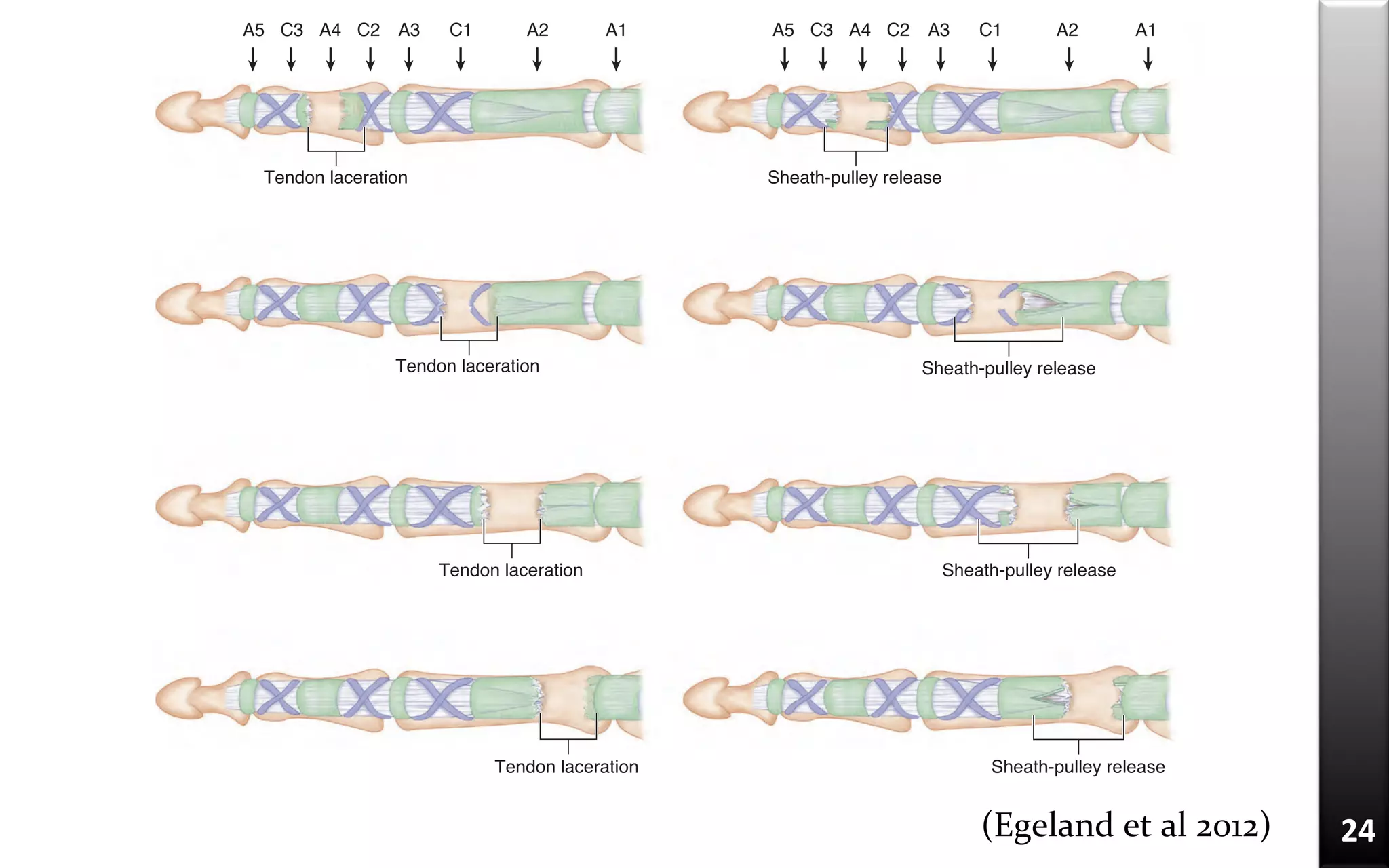 Flexor Tendon Injury | PDF