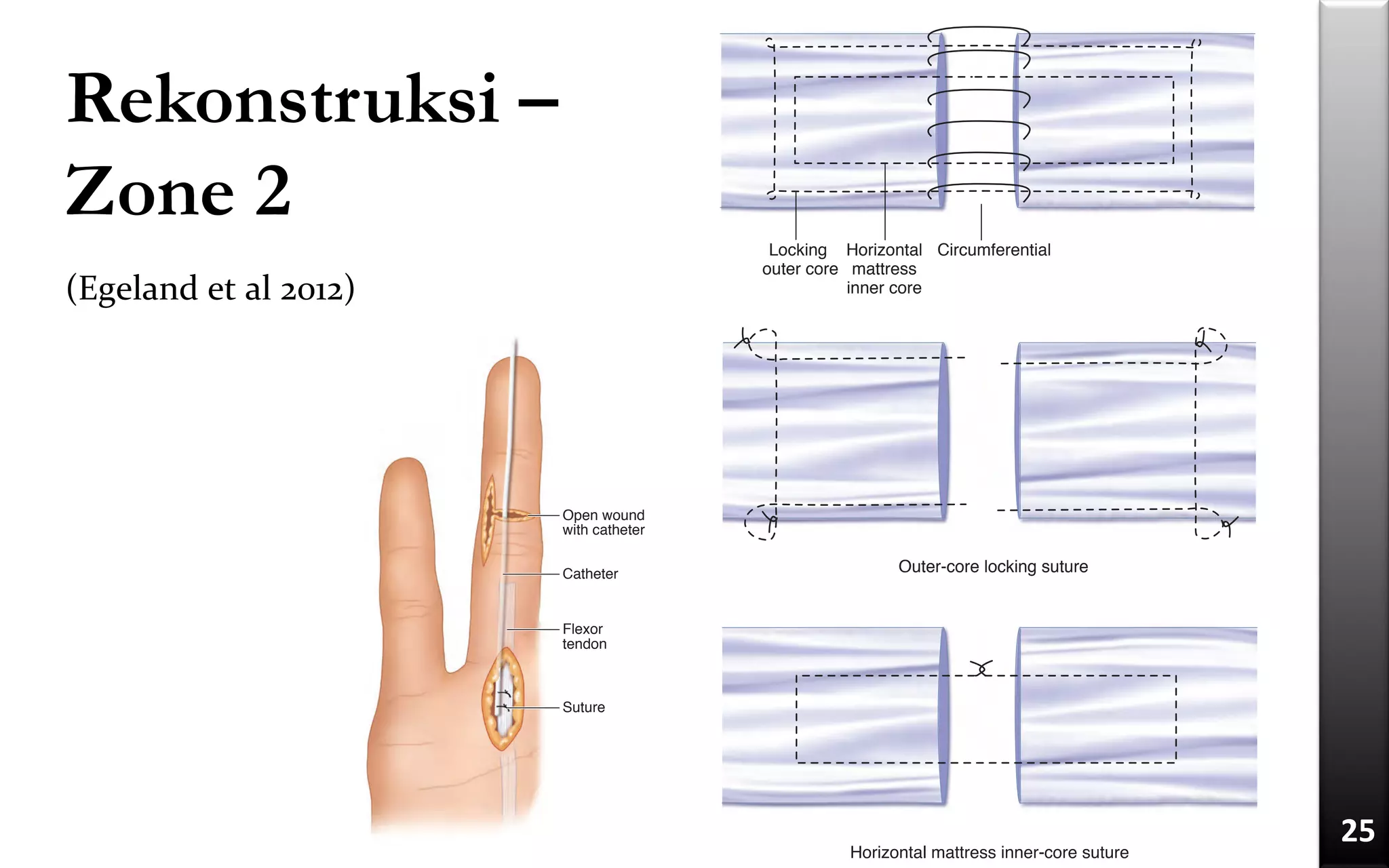 Flexor Tendon Injury | PDF