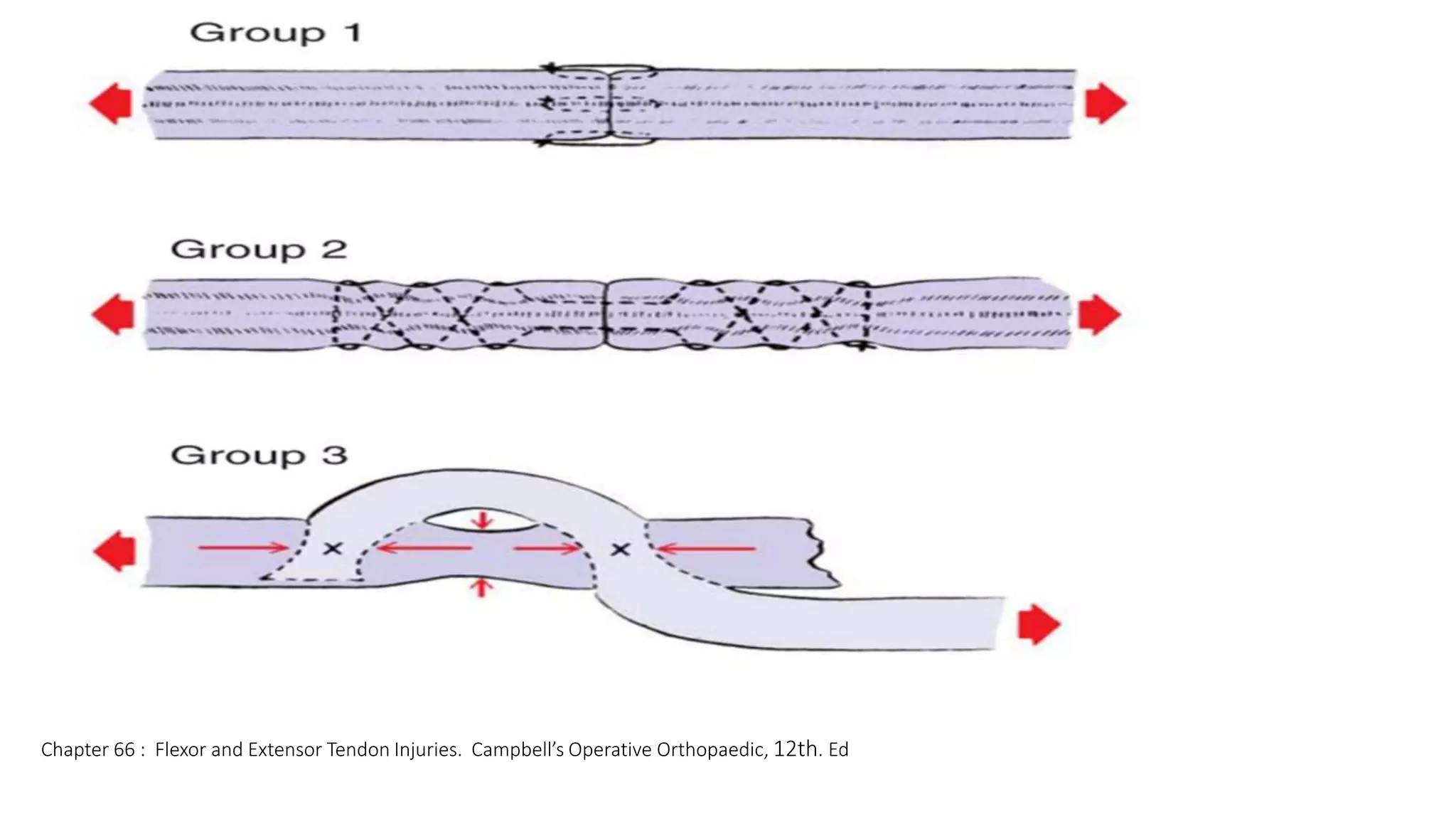 Flexor tendon injury, management and rehabilitation | PPTX