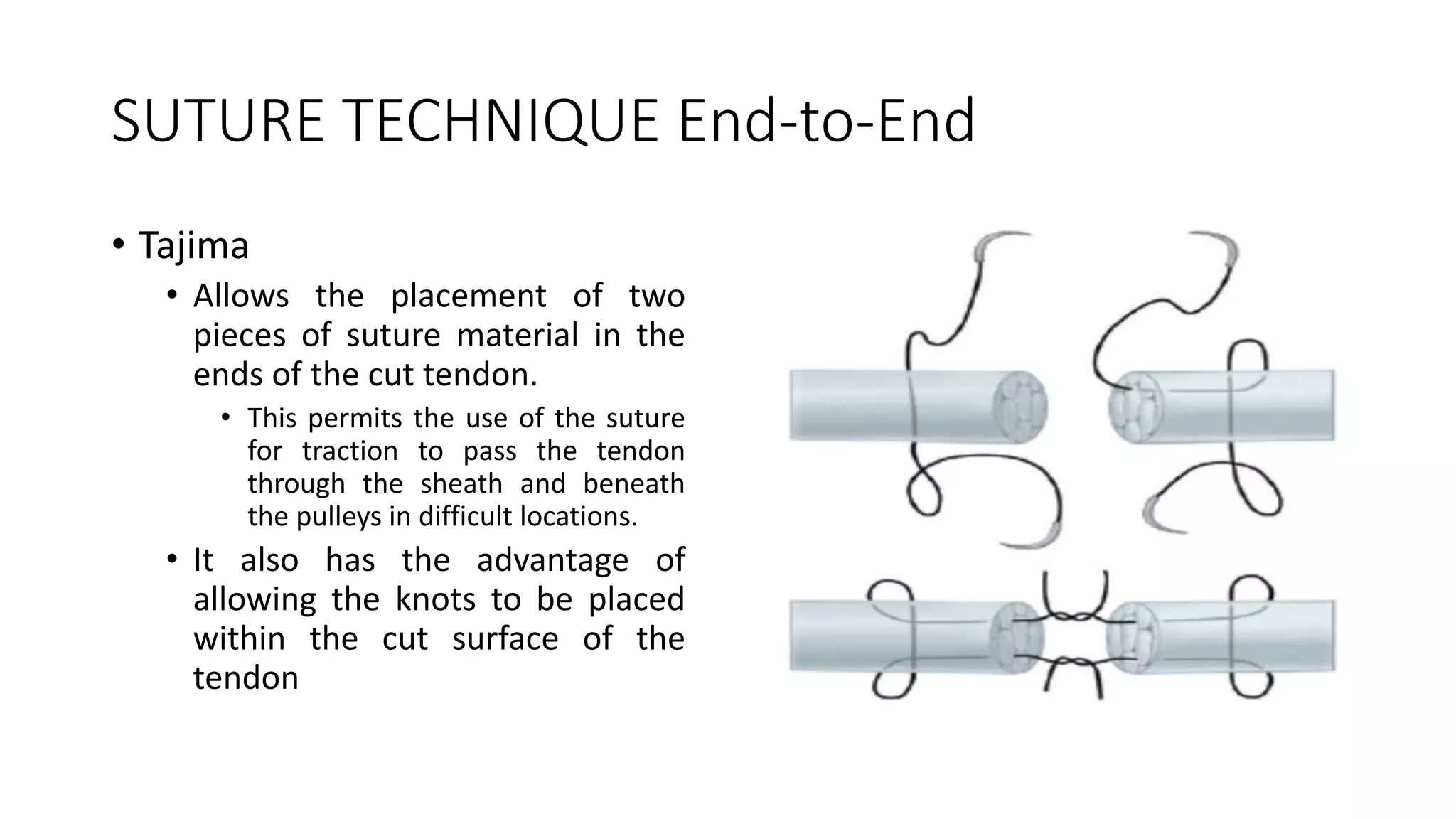 Flexor tendon injury, management and rehabilitation | PPTX