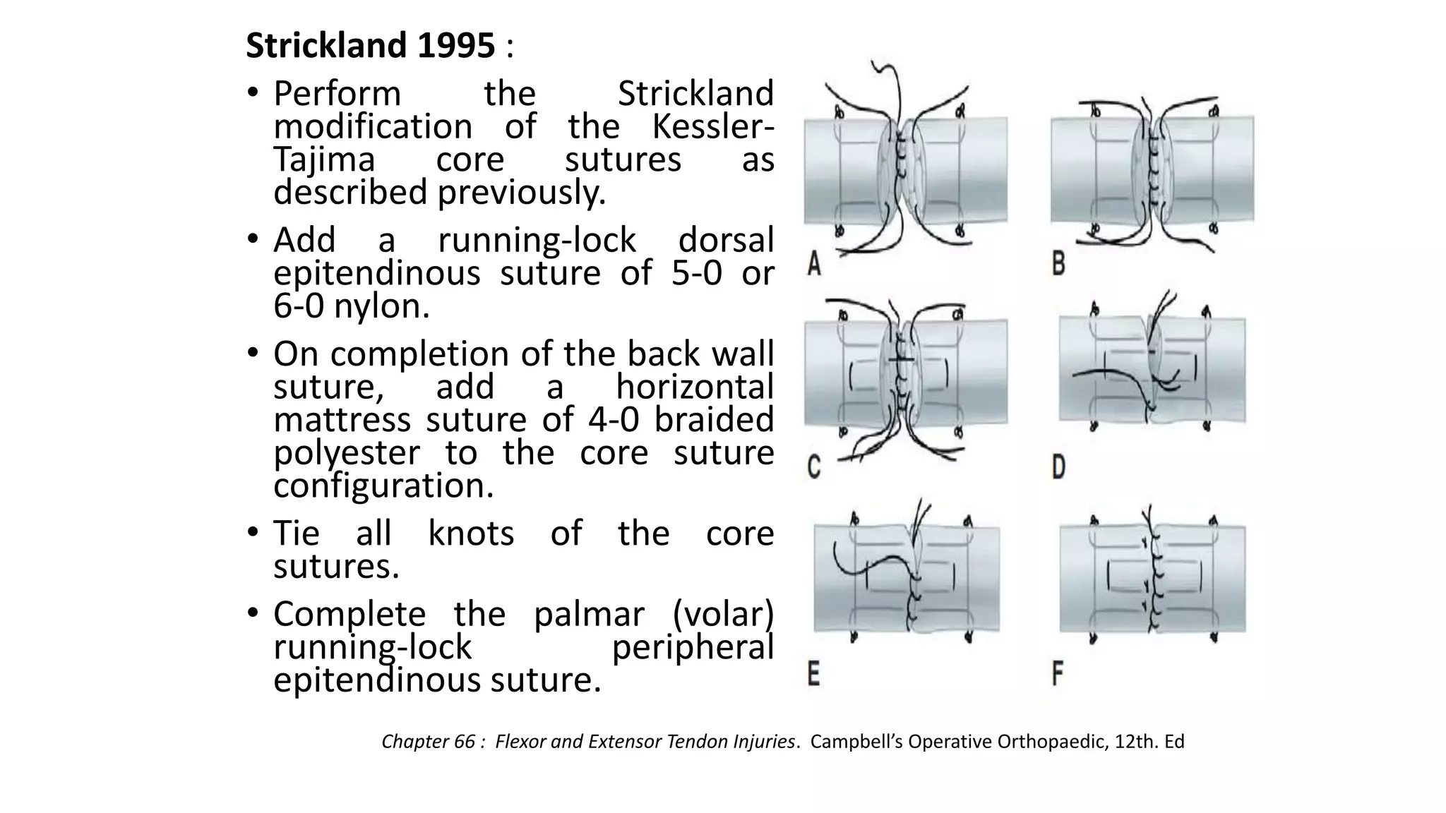 Flexor tendon injury, management and rehabilitation | PPTX