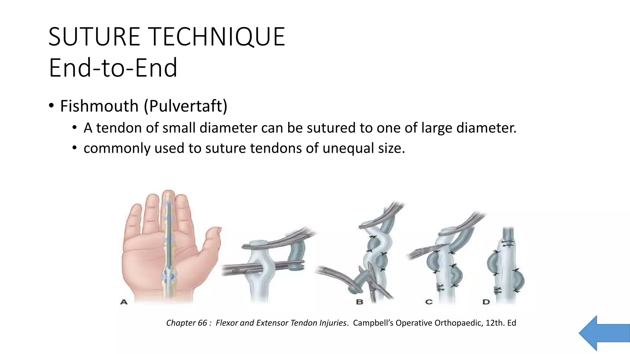 Flexor tendon injury, management and rehabilitation | PPTX