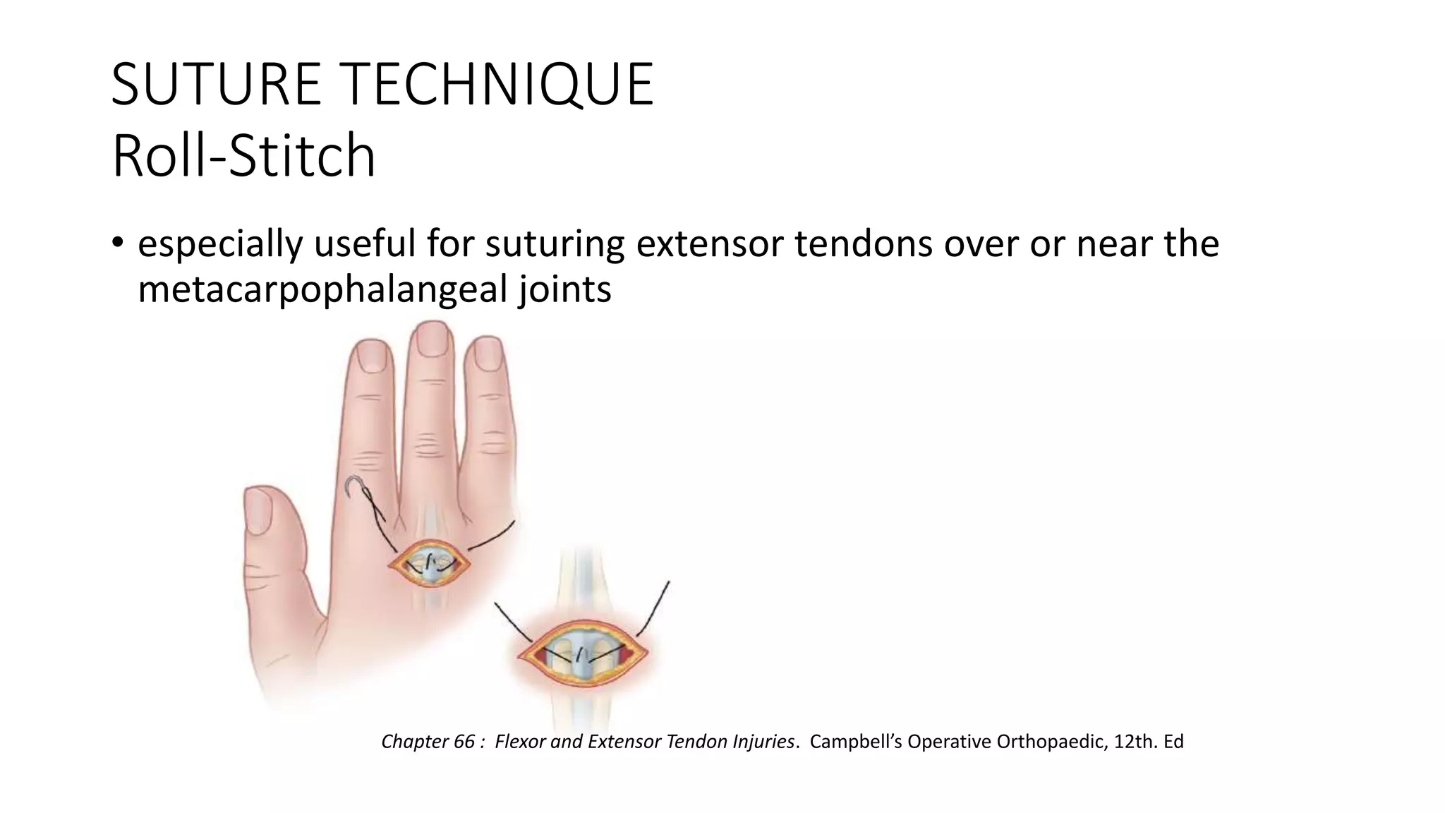 Flexor tendon injury, management and rehabilitation | PPTX