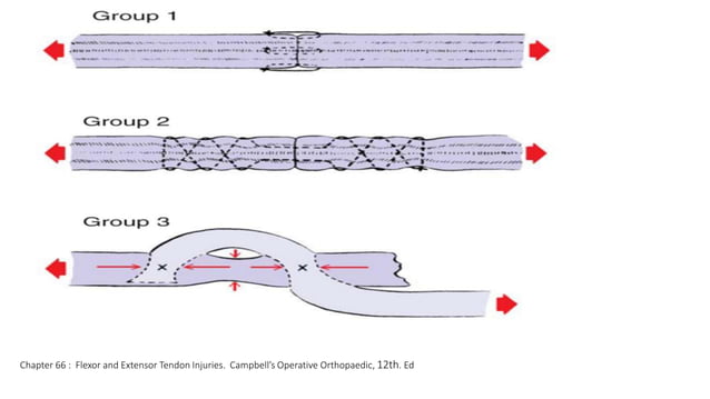 Flexor tendon injury, management and rehabilitation | PPTX | Death ...