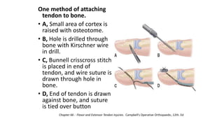 Flexor tendon injury, management and rehabilitation | PPTX